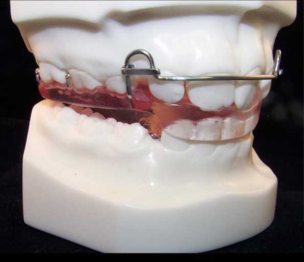 Orthodontie behandeling: 3 fases, apparatuuroverzicht & mondhygiëne