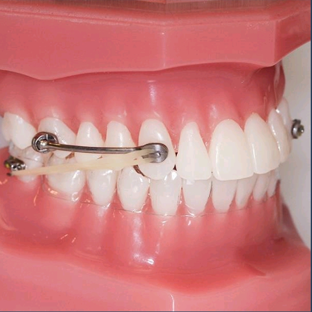 Orthodontie behandeling: 3 fases, apparatuuroverzicht & mondhygiëne